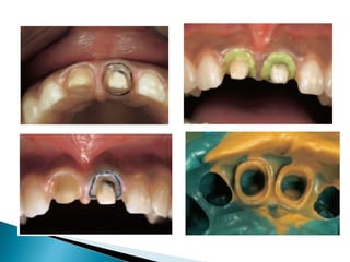3 impression techniques and temporization.ppt