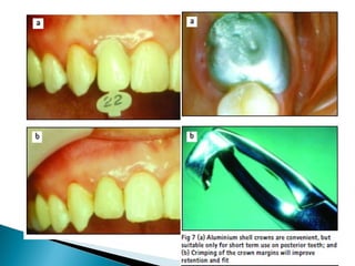 3 impression techniques and temporization.ppt