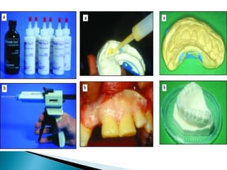 3 impression techniques and temporization.ppt