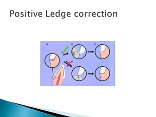 3 impression techniques and temporization.ppt