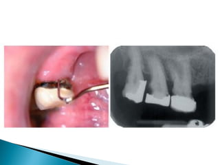 3 impression techniques and temporization.ppt