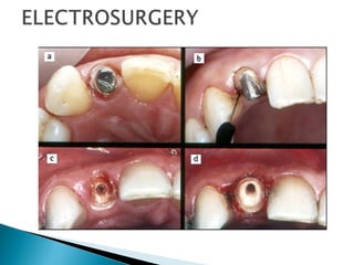 3 impression techniques and temporization.ppt