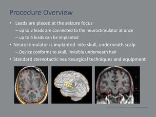 Responsive Neurostimulation (RNS) for Intractable Epilepsy | PPTX