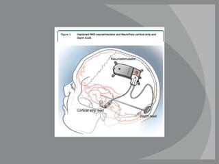 Responsive Neurostimulation (RNS) for Intractable Epilepsy | PPTX
