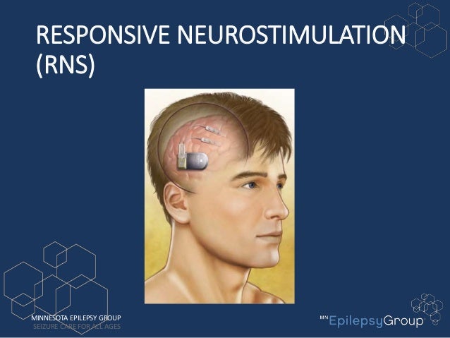 Responsive Neurostimulation (RNS) for Intractable Epilepsy
