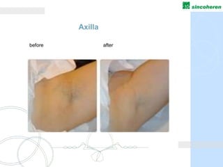 Beijing Sincoheren 3 in one diode laser introduction | PPT