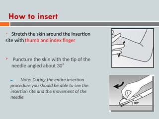 3 insertion and removal of implanon ppt | PPT
