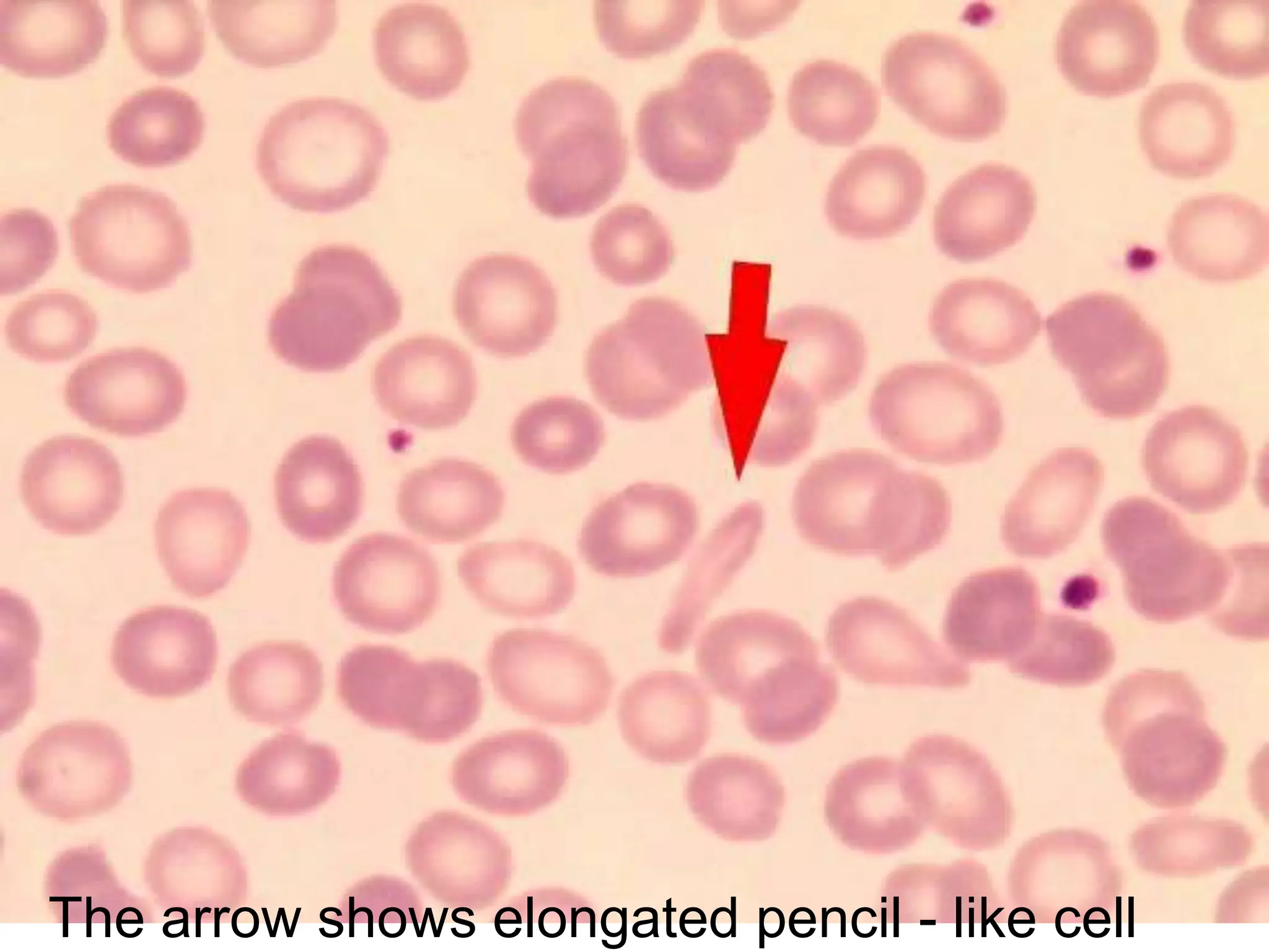 3 iron deficiency anemia blood diseases.ppt
