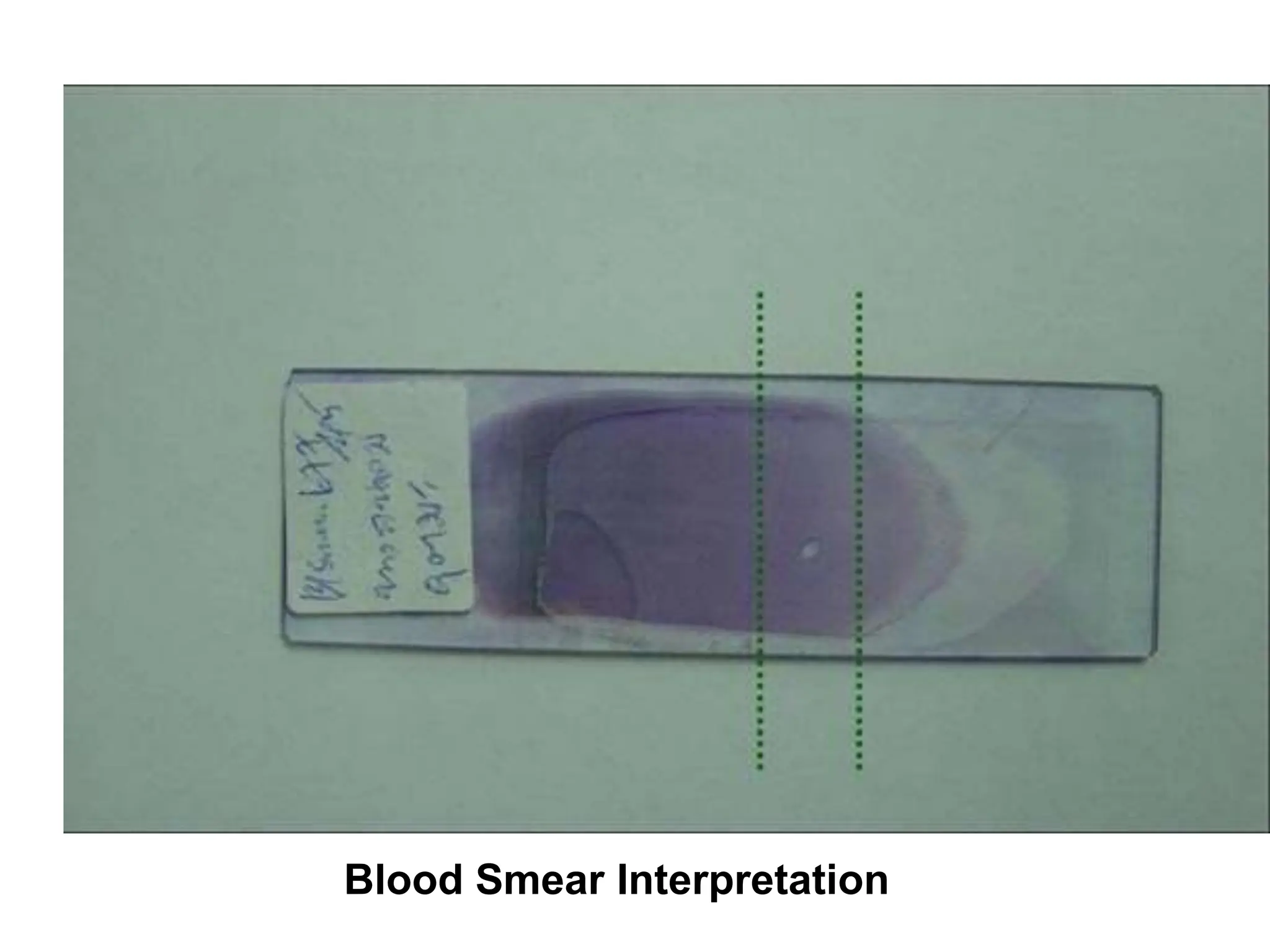 3 iron deficiency anemia blood diseases.ppt