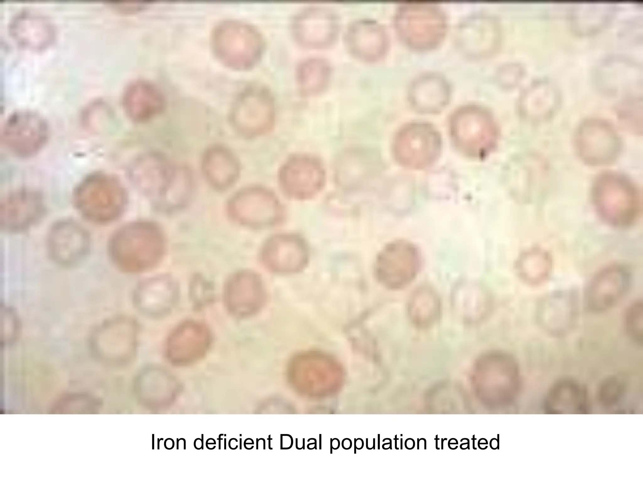 3 iron deficiency anemia blood diseases.ppt