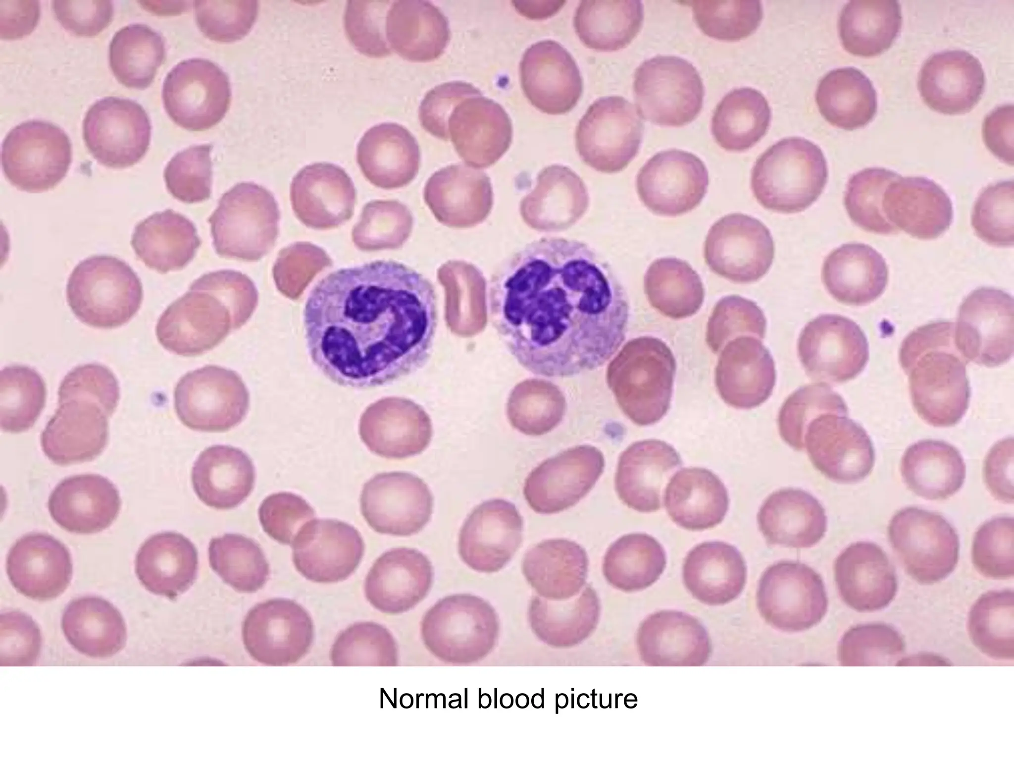 3 iron deficiency anemia blood diseases.ppt