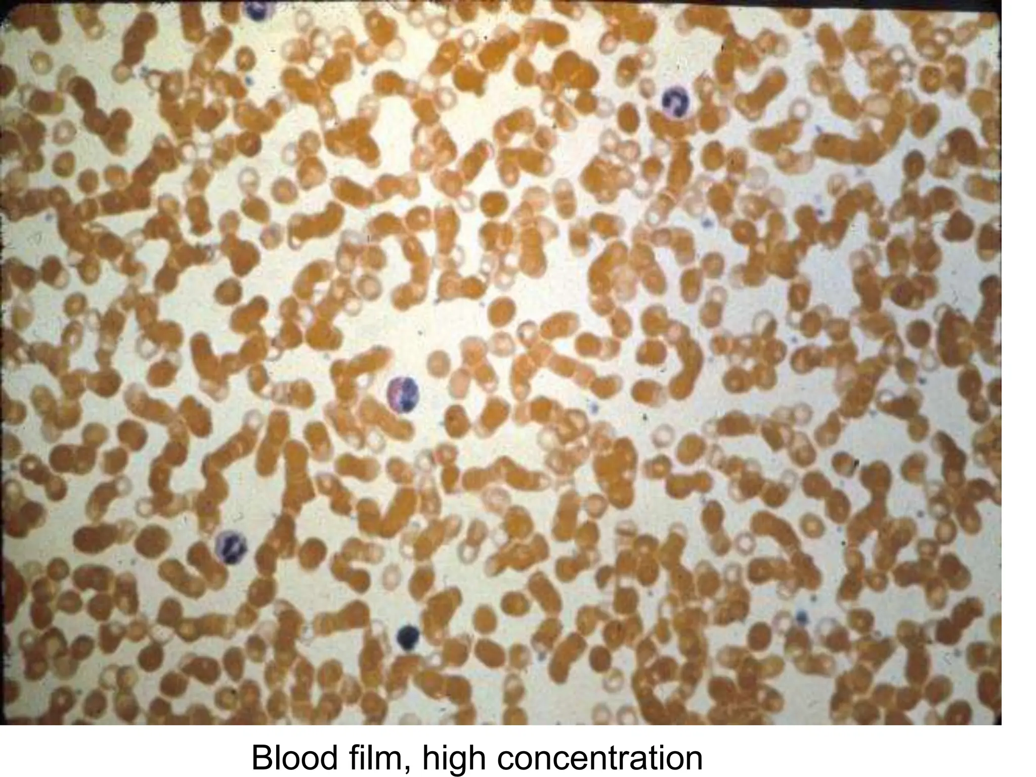 3 iron deficiency anemia blood diseases.ppt
