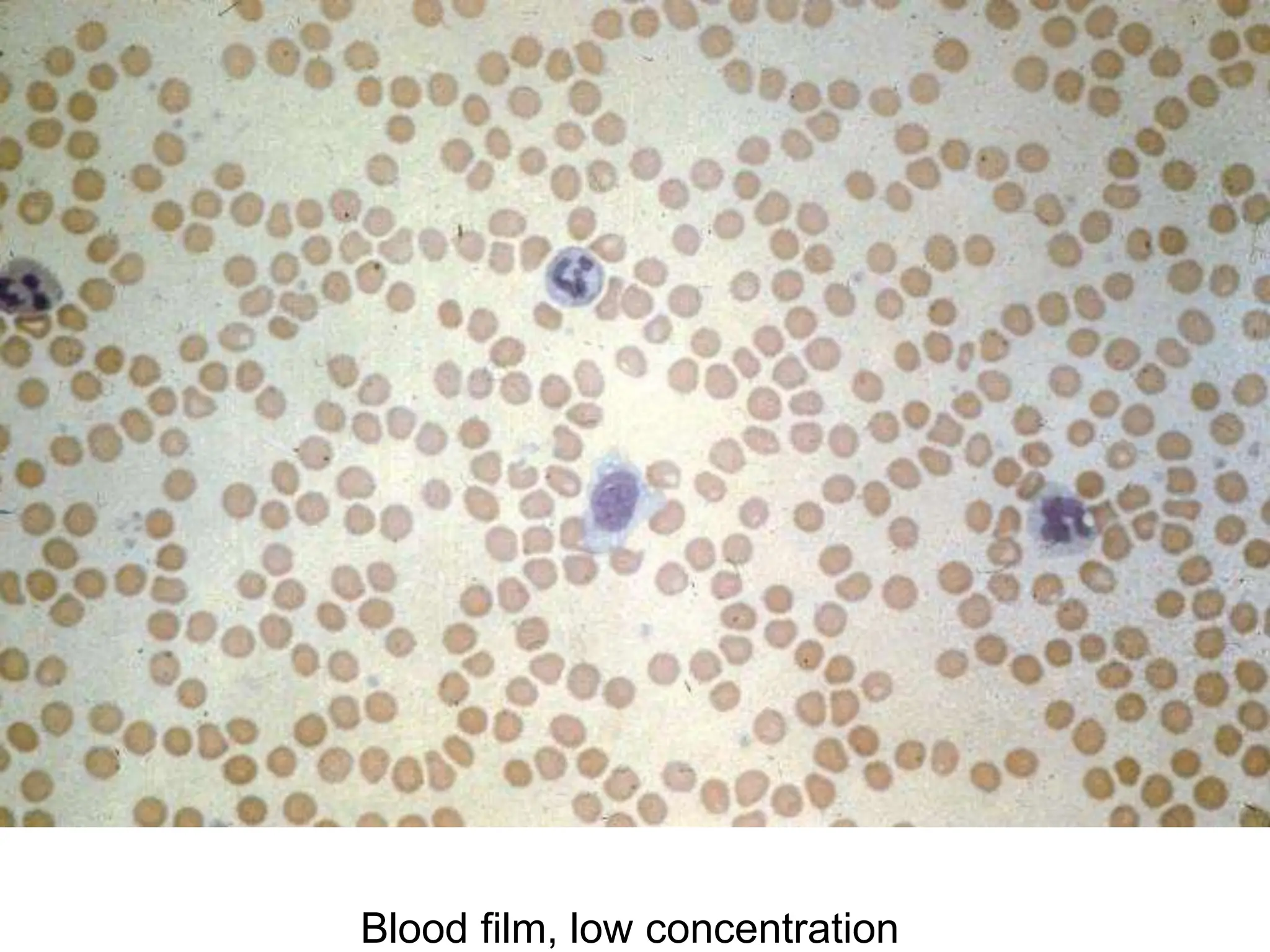 3 iron deficiency anemia blood diseases.ppt