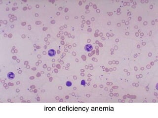 3 iron deficiency anemia blood diseases.ppt