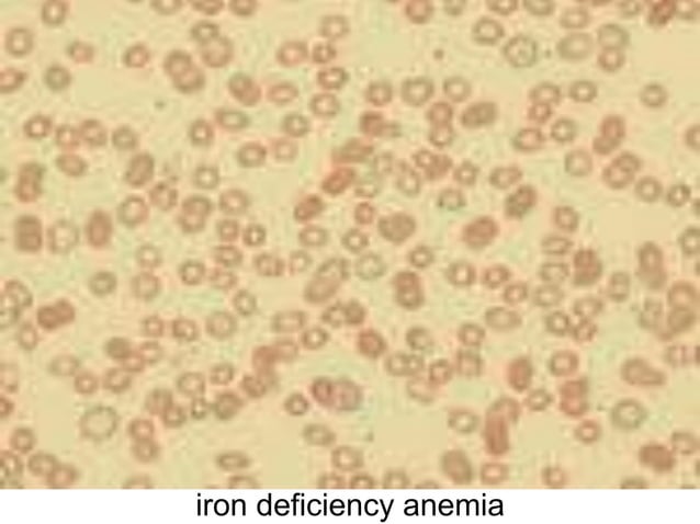 3 iron deficiency anemia blood diseases.ppt