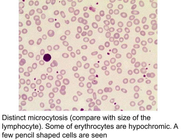 3 iron deficiency anemia blood diseases.ppt