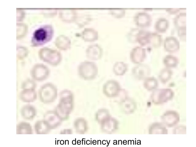 3 iron deficiency anemia blood diseases.ppt