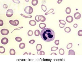 3 iron deficiency anemia blood diseases.ppt