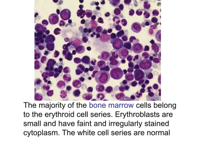 3 iron deficiency anemia blood diseases.ppt