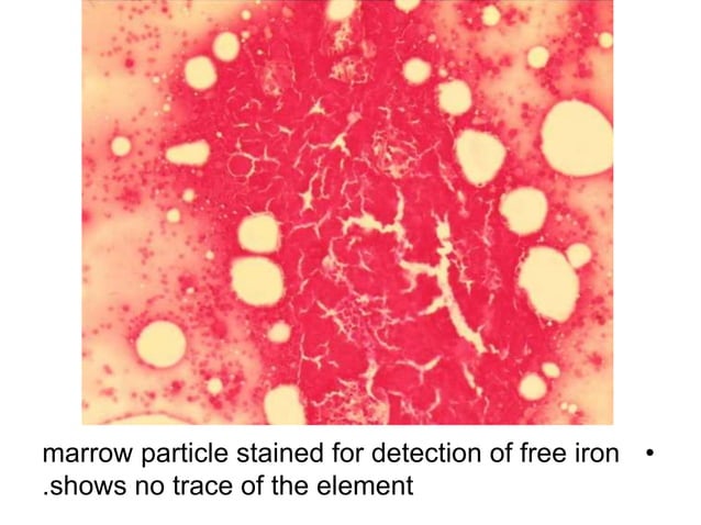 3 iron deficiency anemia blood diseases.ppt