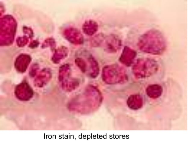 3 iron deficiency anemia blood diseases.ppt