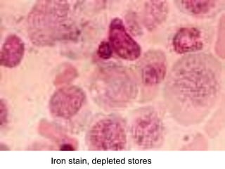 3 iron deficiency anemia blood diseases.ppt