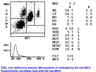 3 iron deficiency anemia blood diseases.ppt