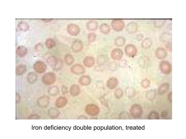 3 iron deficiency anemia blood diseases.ppt