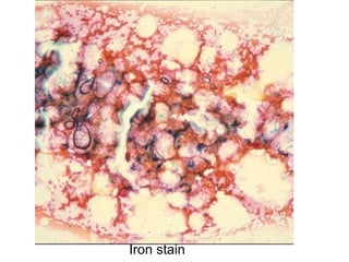 3 iron deficiency anemia blood diseases.ppt