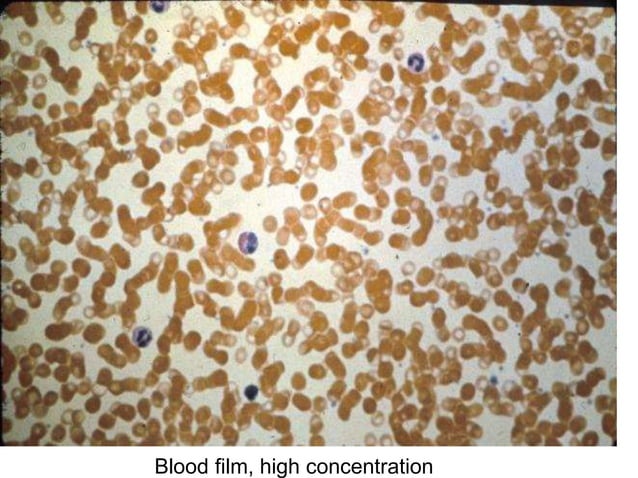 3 iron deficiency anemia blood diseases.ppt