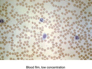 3 iron deficiency anemia blood diseases.ppt