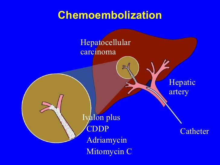3 kwo hepatocellular cancer