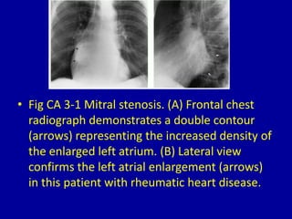 3 left atrial enlargement | PPTX