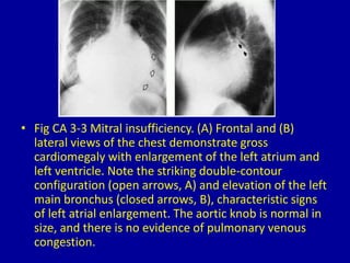 3 left atrial enlargement | PPTX