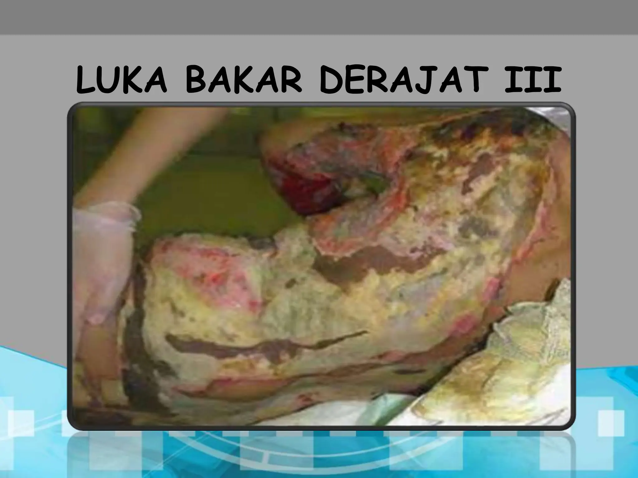 3 Luka Bakar.pptx dan penanganan yang bisa dilakukan | PPTX