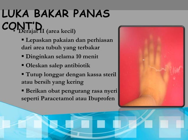 3 Luka Bakar.pptx dan penanganan yang bisa dilakukan | PPTX