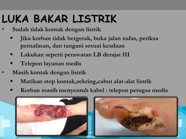 3 Luka Bakar.pptx dan penanganan yang bisa dilakukan | PPTX