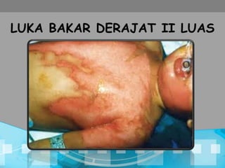 3 Luka Bakar.pptx dan penanganan yang bisa dilakukan | PPTX