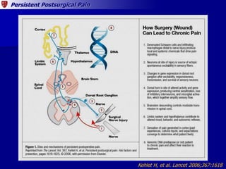 Regional Anesthesia in the Prevention of Persistent Postsurgical Pain ...