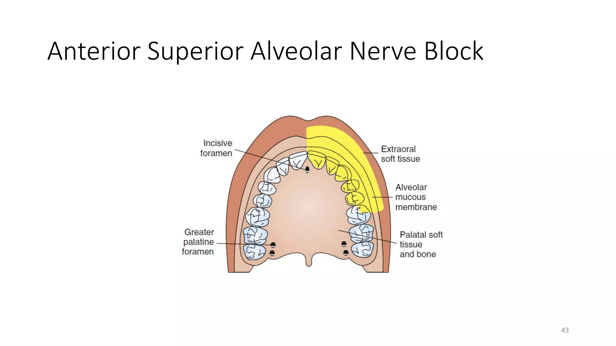 3 MAXILLARY NERVE BLOCKS seminar 3.pptx
