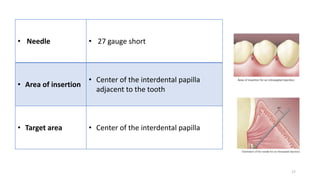 3 MAXILLARY NERVE BLOCKS seminar 3.pptx