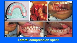 Lecture 3 maxillofacial trauma part 3 | PPTX