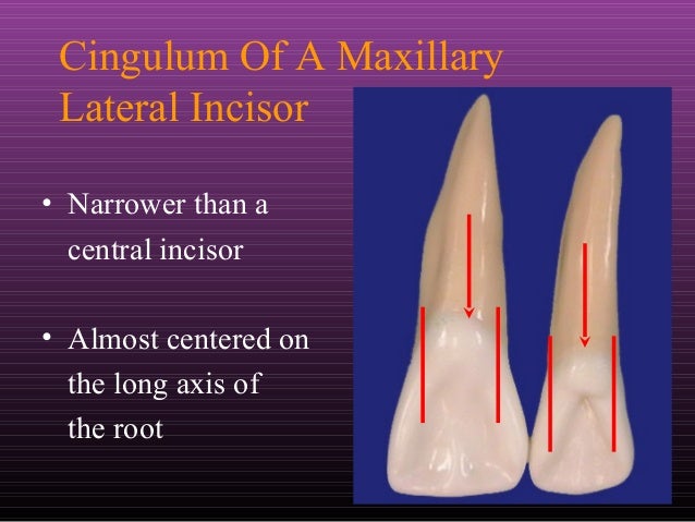 Maxillary Lateral and Mandibular Incisors