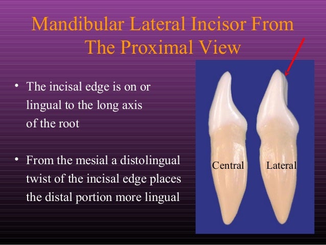 Maxillary Lateral and Mandibular Incisors