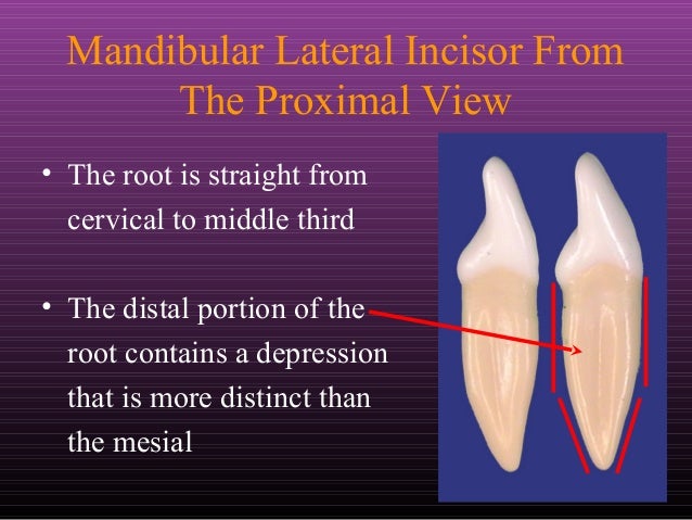 Maxillary Lateral and Mandibular Incisors