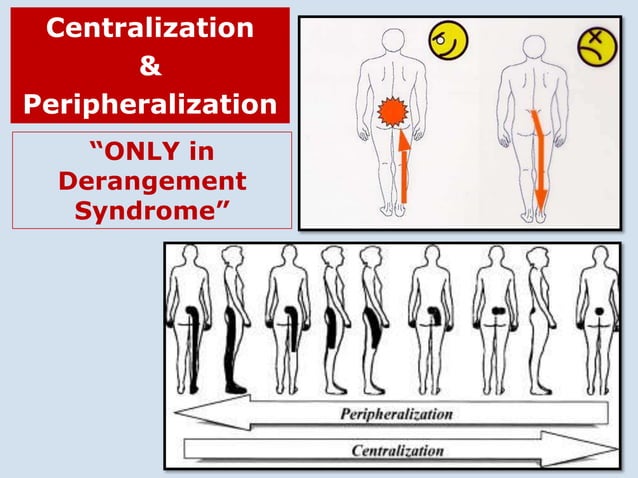 Mckenzie approach, Mechanical Diagnosis Therapy, Directional preference ...