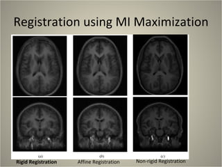 Mutual Information Algorithm applied to rigid registration | PDF