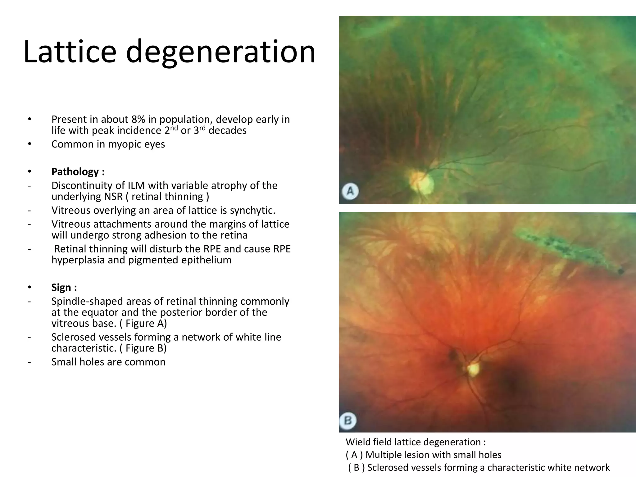 3 mirror, retinal break.pptx