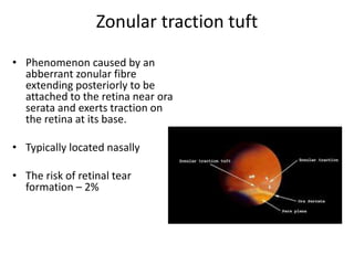 3 mirror, retinal break.pptx