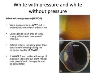 3 mirror, retinal break.pptx